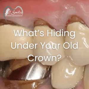 The Hidden Dangers Beneath Old Dental Crowns All Smiles Dentistry Allen